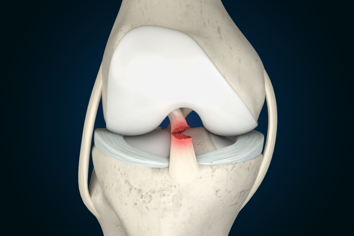 Ce este ruptura de ligament, care sunt simptomele și opțiunile de ...